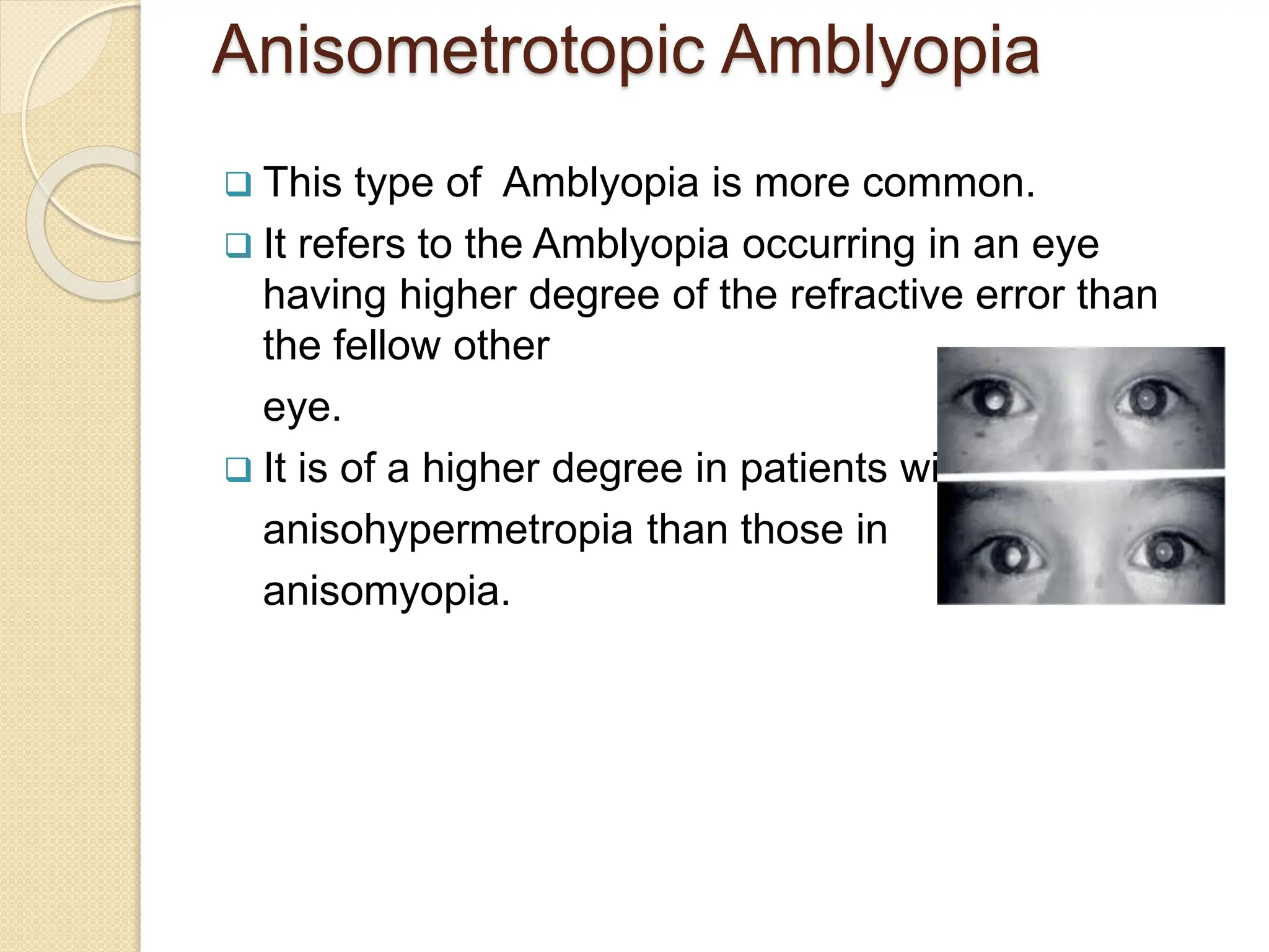 AMBLYOPIA (LAZY EYE).pptx lasy eye human disorder | PPTX