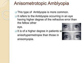 AMBLYOPIA (LAZY EYE).pptx lasy eye human disorder | PPTX