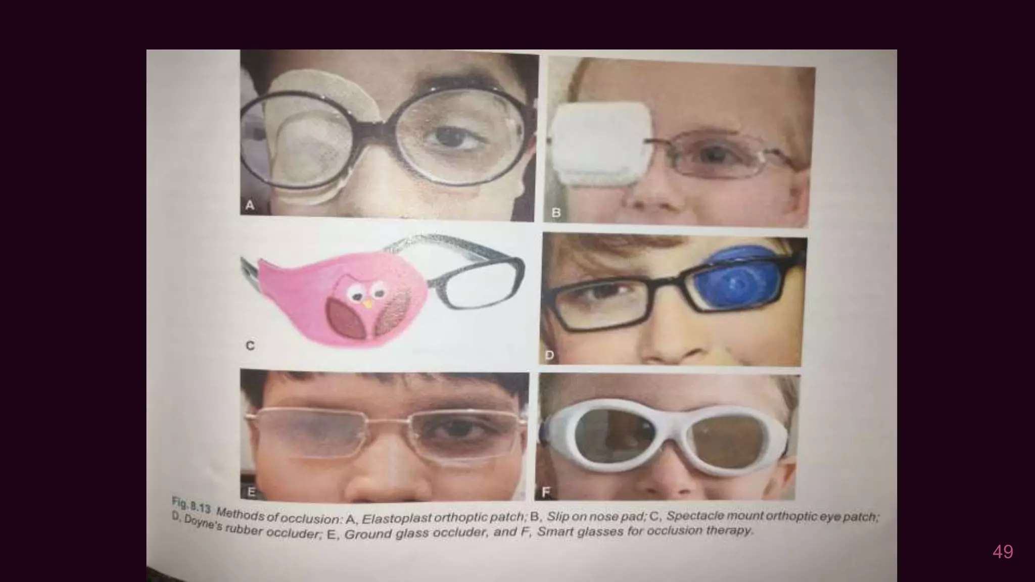 AMBLYOPIA & Modern Treatment Options.pptx