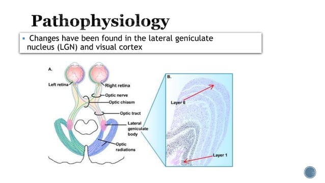 amblyopia ppt.edit.pptx