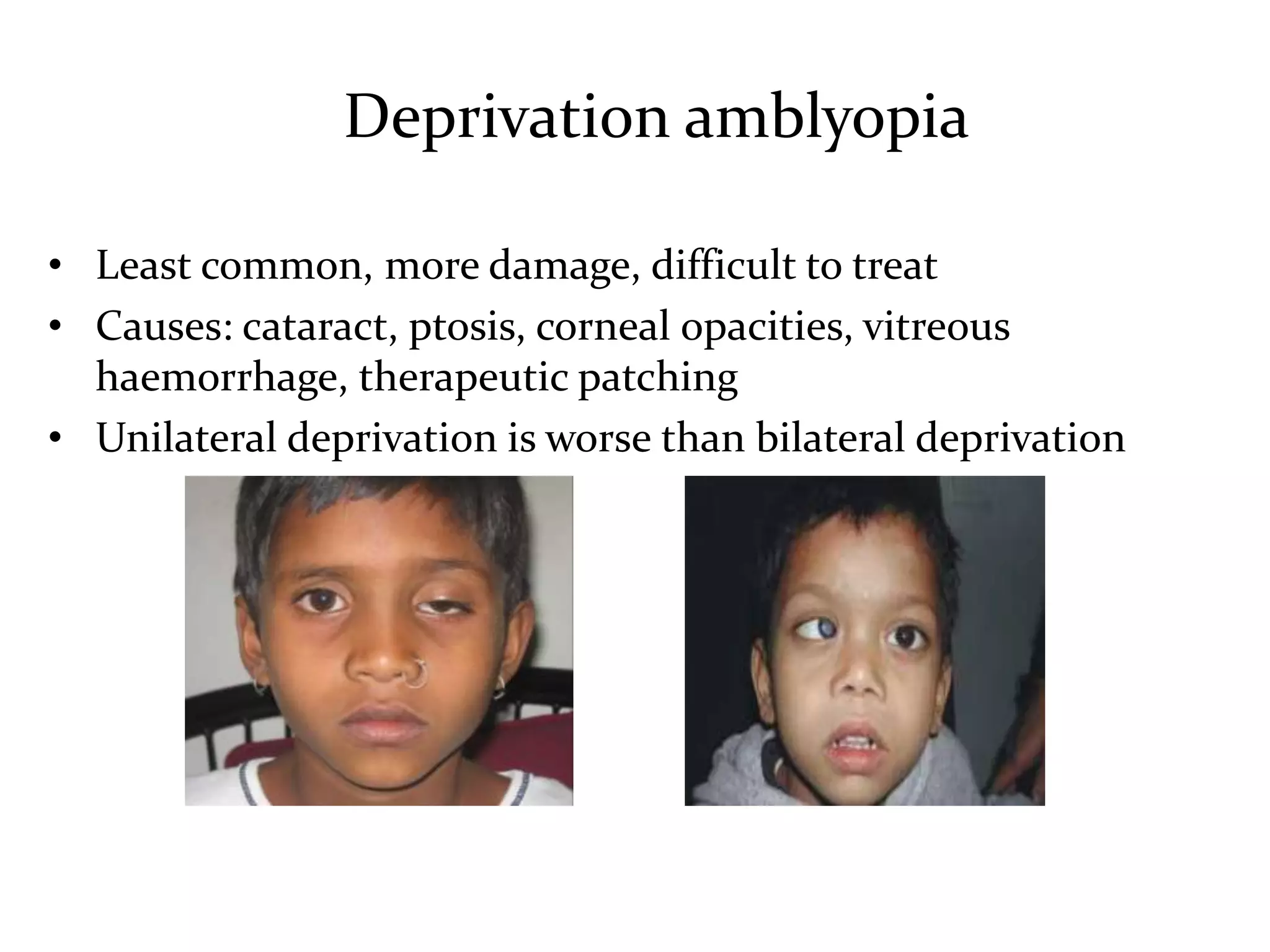 Amblyopia | PPTX