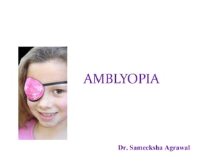Amblyopia | PPTX