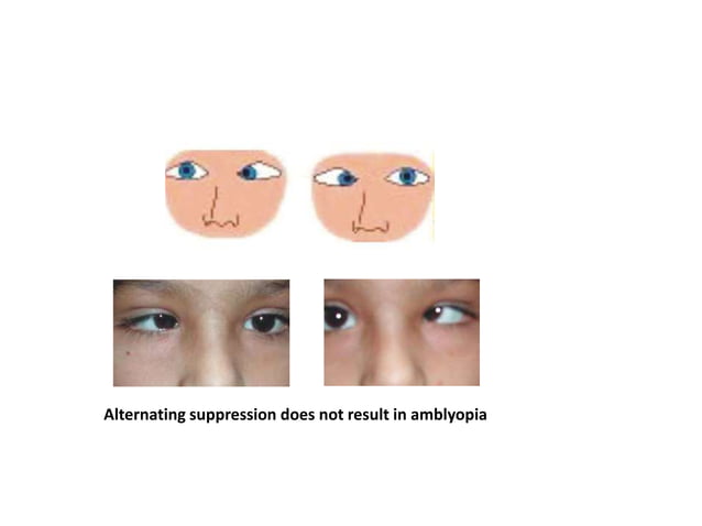 Amblyopia | PPTX | Eye and Vision Conditions | Diseases and Conditions