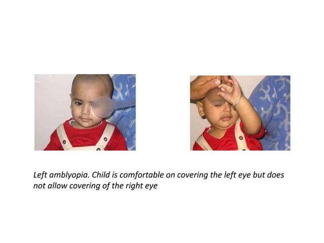 Amblyopia | PPTX | Eye and Vision Conditions | Diseases and Conditions