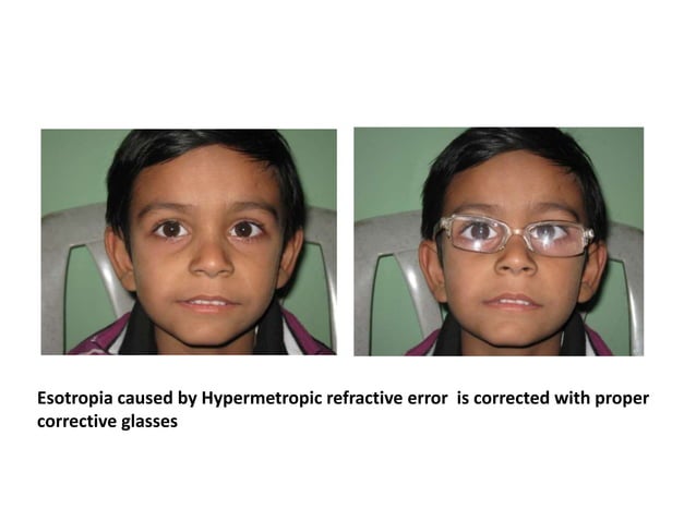 Amblyopia | PPTX | Eye and Vision Conditions | Diseases and Conditions