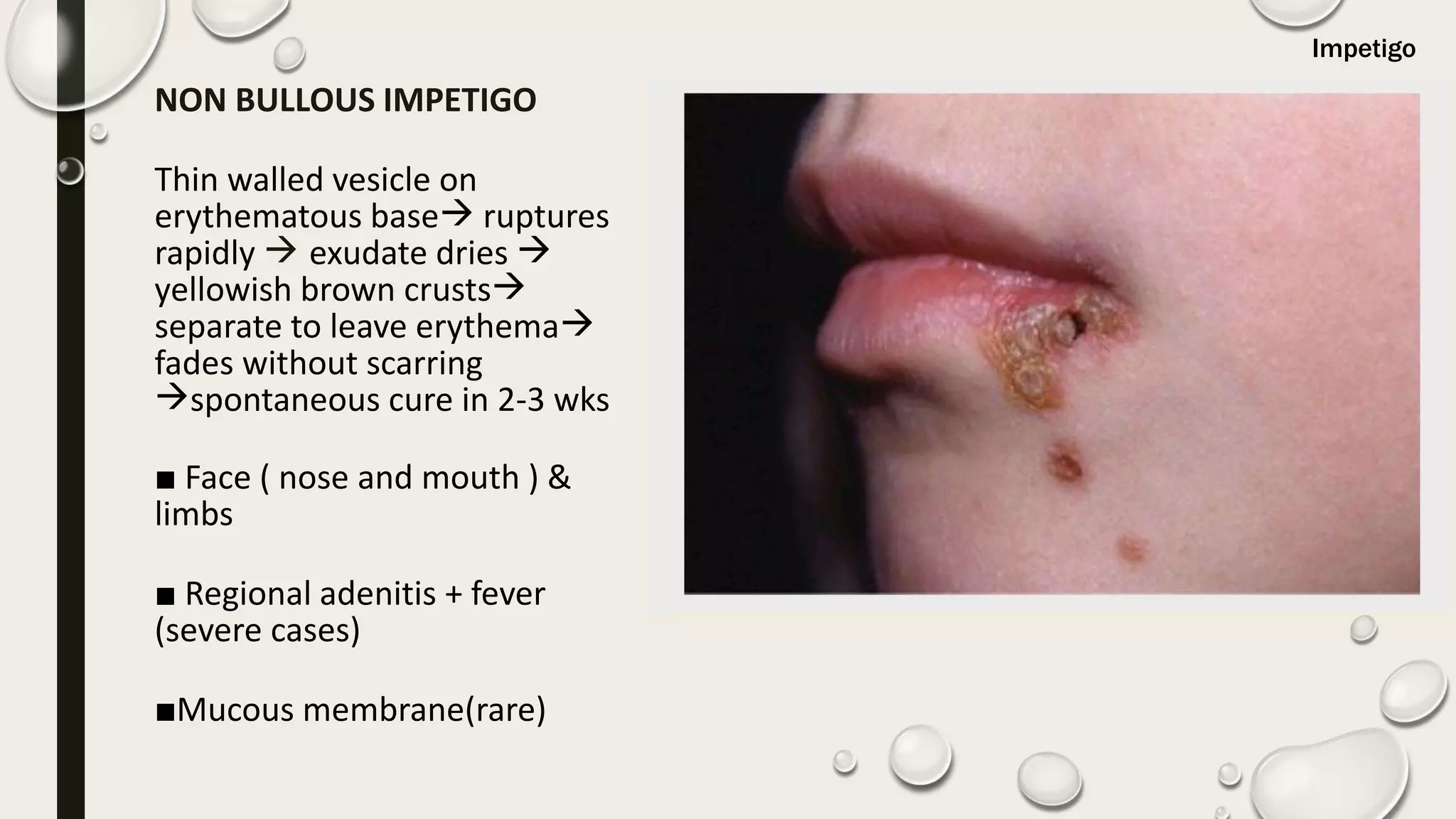 BACTERIAL120INFECTIONS.pptx
