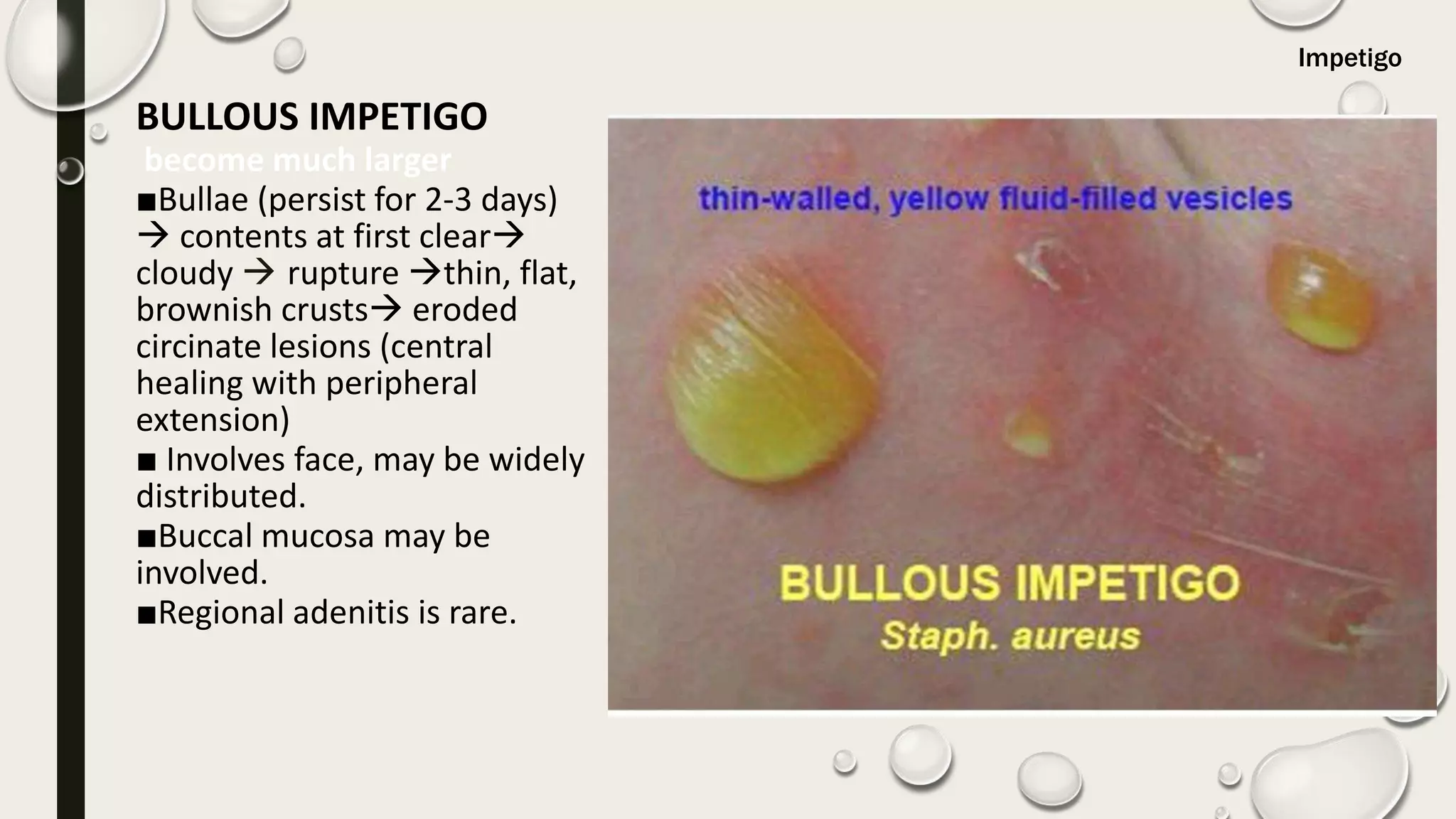 BACTERIAL120INFECTIONS.pptx