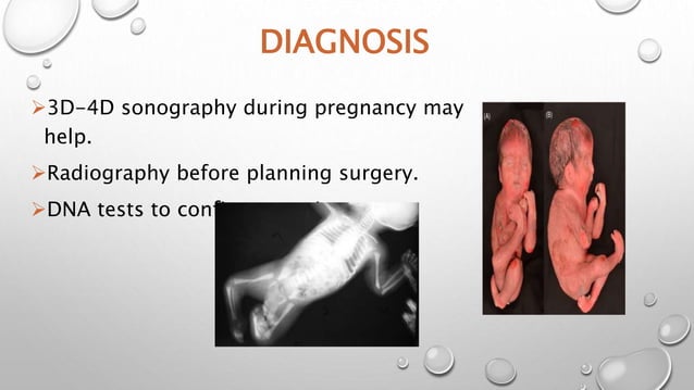 Arthrogryposis Multiplex Congenita | PPTX