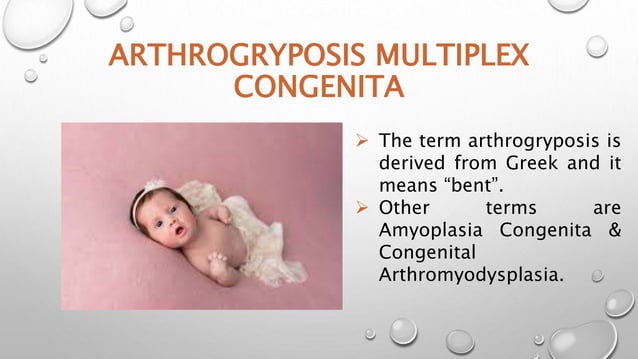 Arthrogryposis Multiplex Congenita | PPTX
