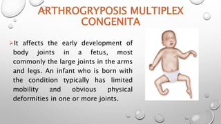 Arthrogryposis Multiplex Congenita | PPTX