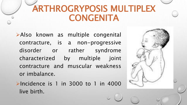 Arthrogryposis Multiplex Congenita | PPTX