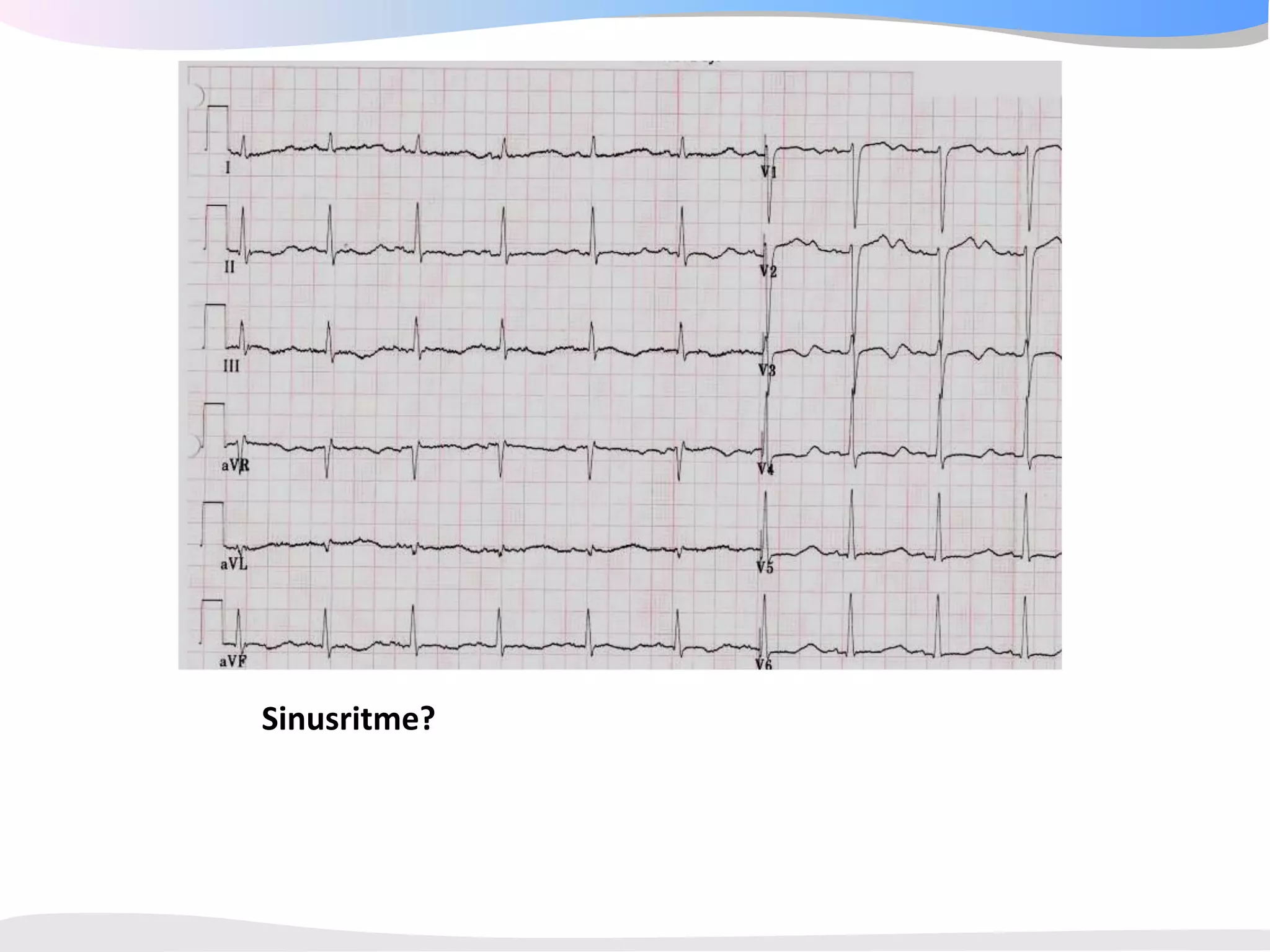 ECGpedia ECG course part I: Basic electrocardiography | PPT