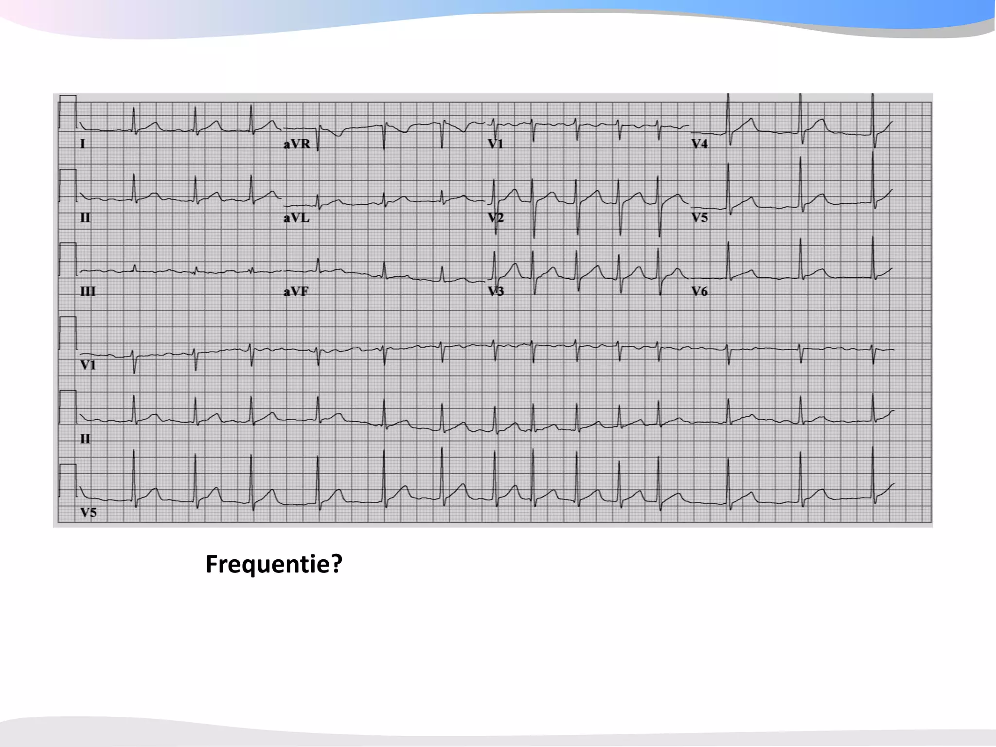 ECGpedia ECG course part I: Basic electrocardiography | PPT