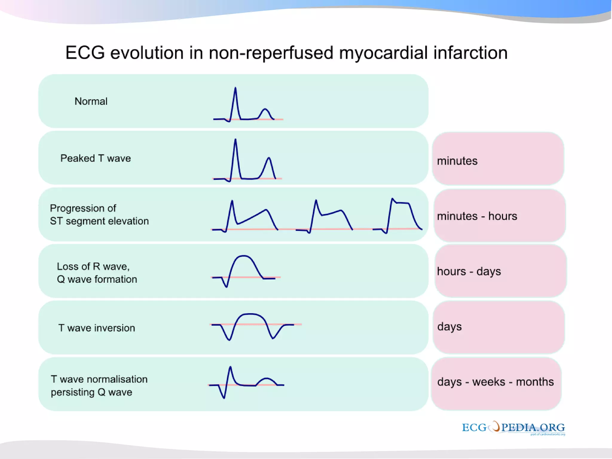 ECGpedia ECG course part II - ischemia, rhythm and conduction | PDF