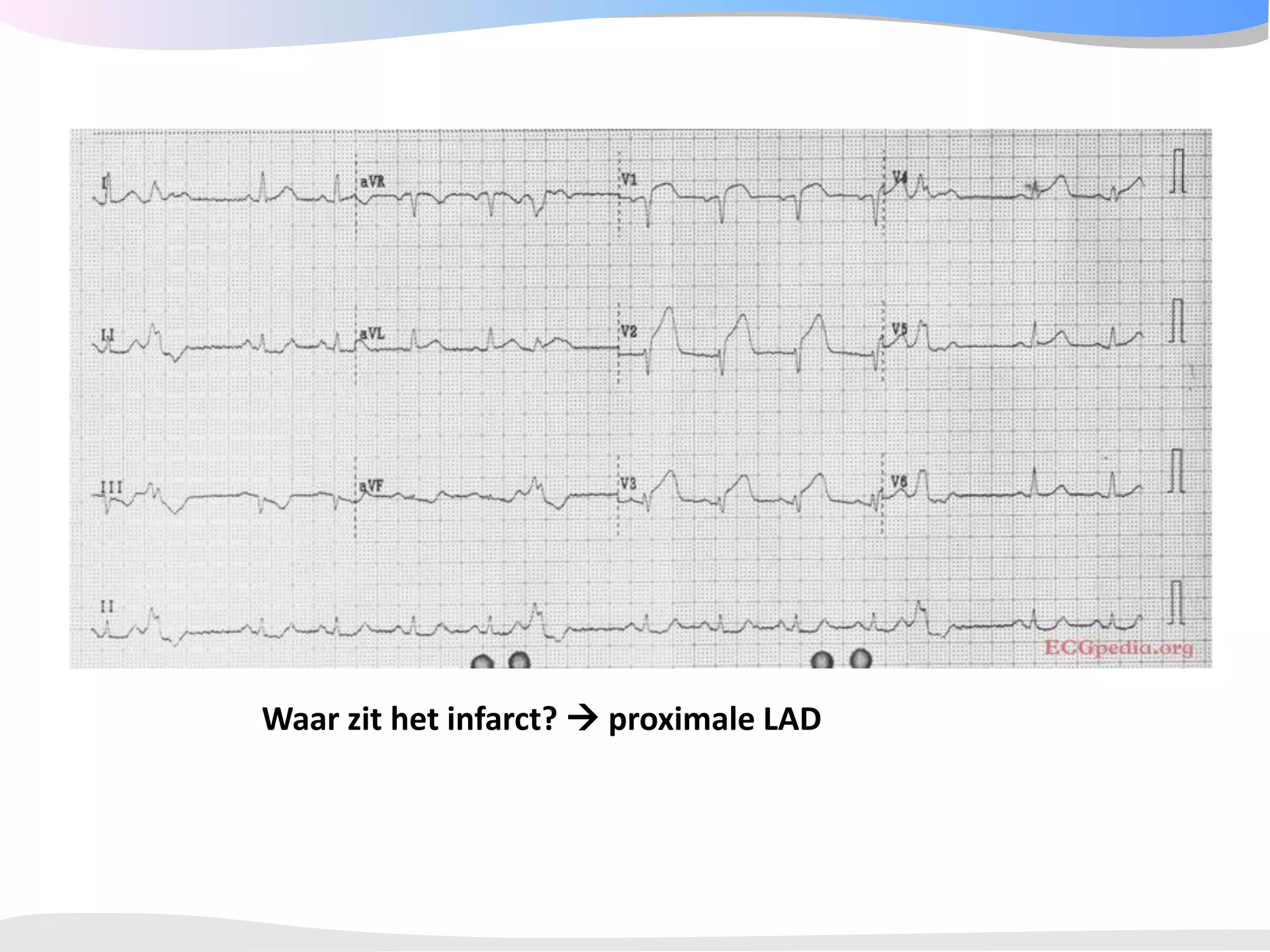 ECGpedia ECG course part II - ischemia, rhythm and conduction | PDF