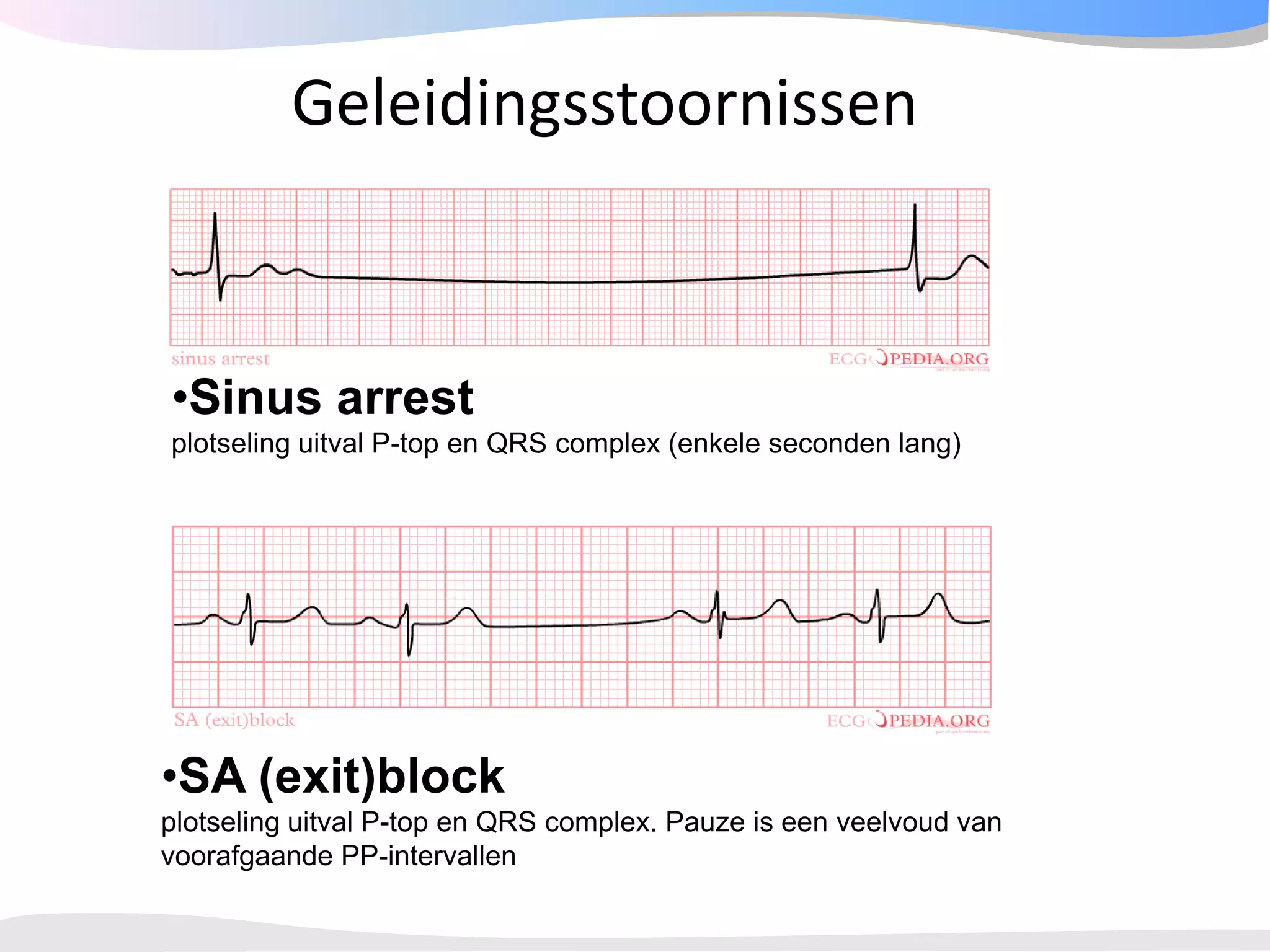 ECGpedia ECG course part II - ischemia, rhythm and conduction | PDF