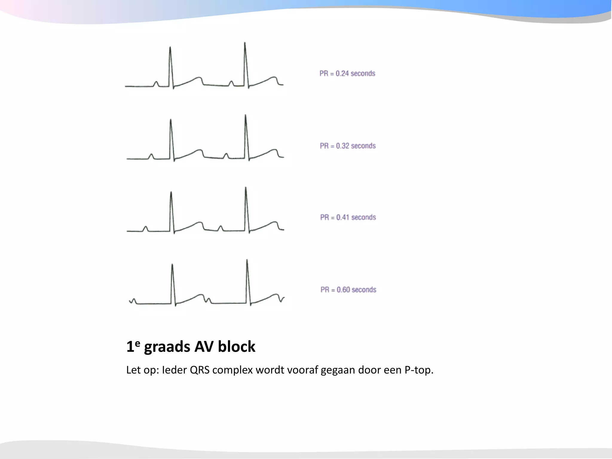 ECGpedia ECG course part II - ischemia, rhythm and conduction | PDF