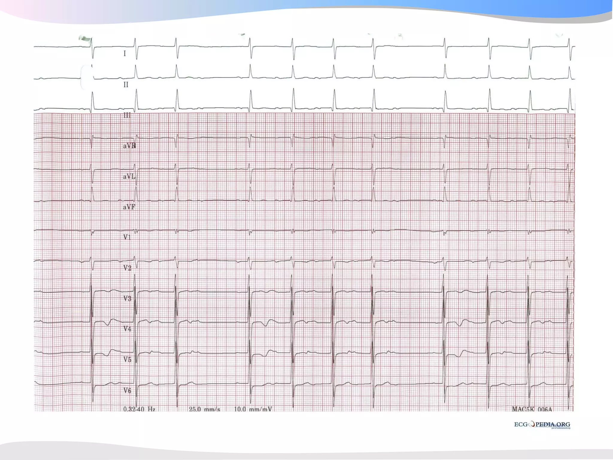 ECGpedia ECG course part II - ischemia, rhythm and conduction | PDF