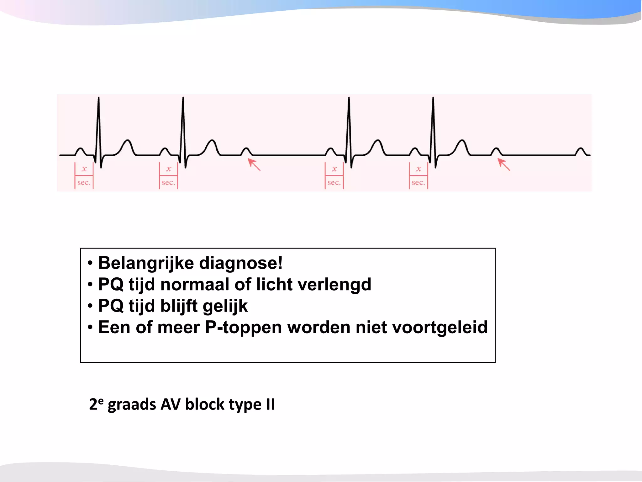 ECGpedia ECG course part II - ischemia, rhythm and conduction | PDF