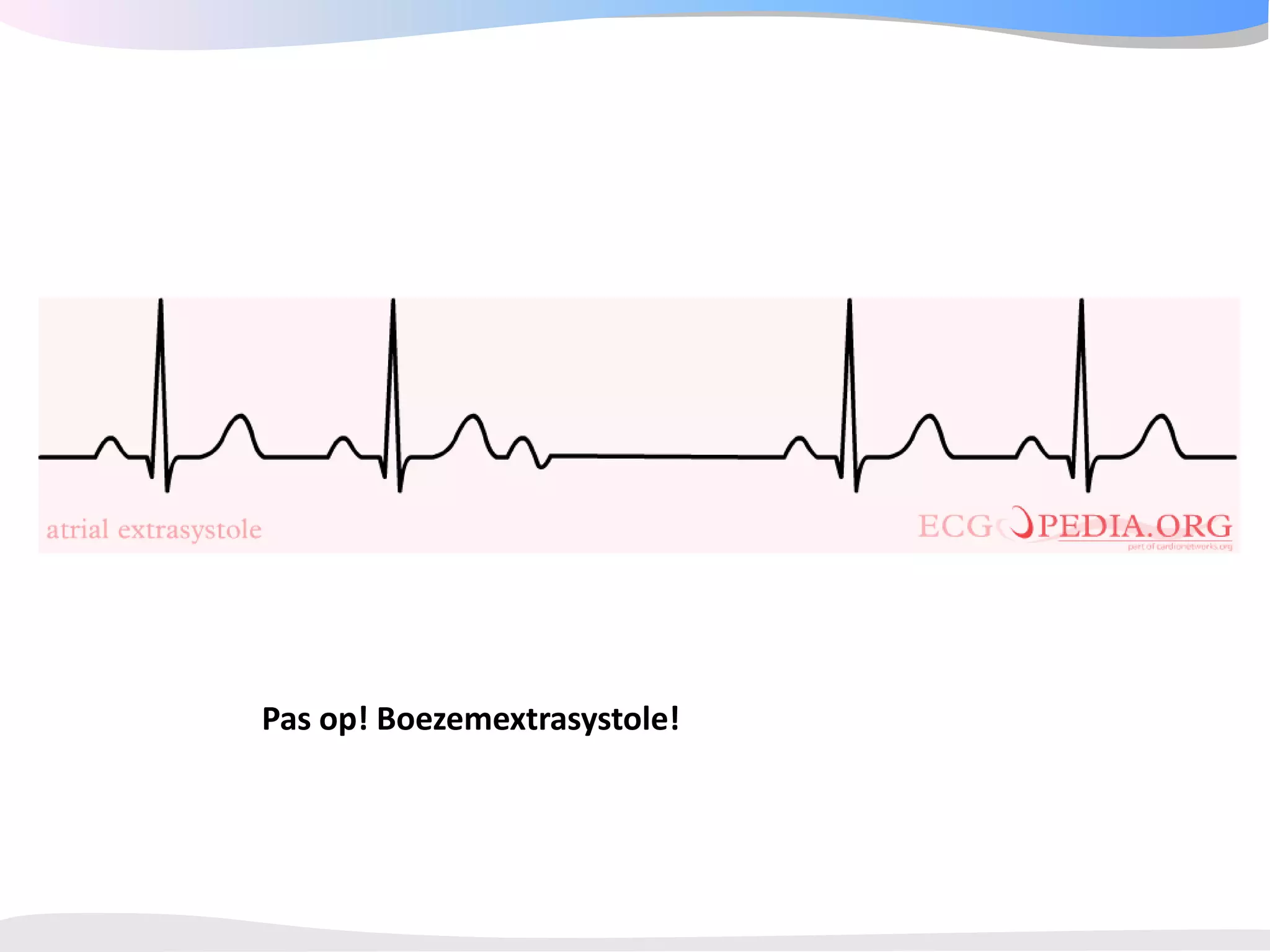 ECGpedia ECG course part II - ischemia, rhythm and conduction | PDF