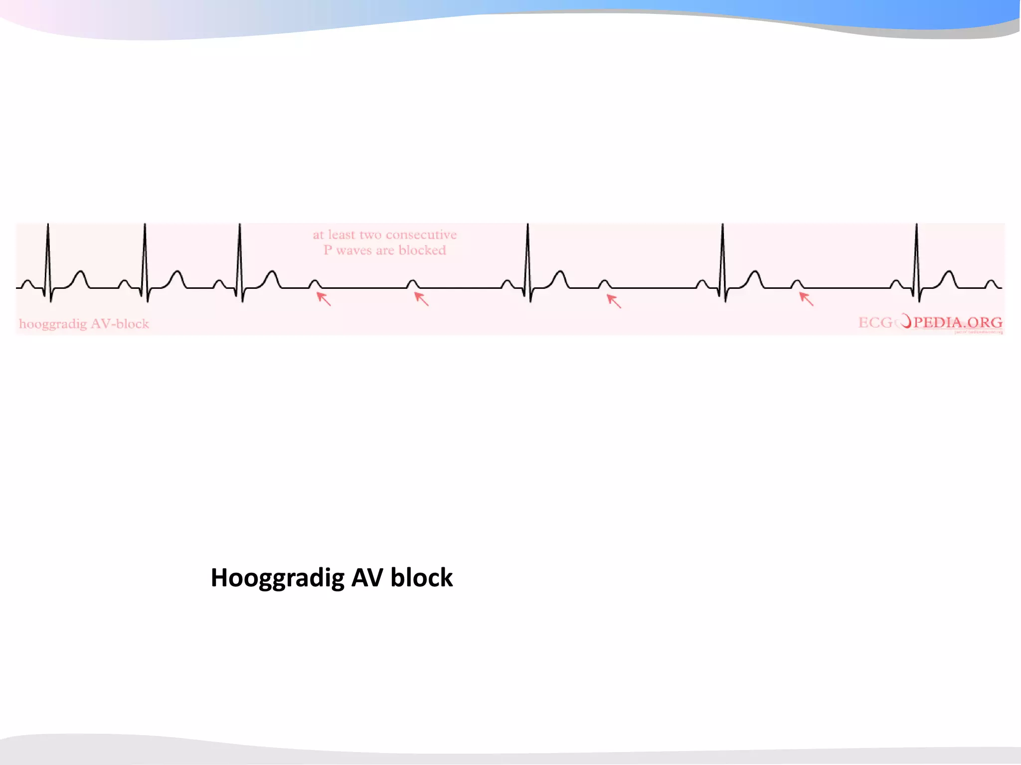 ECGpedia ECG course part II - ischemia, rhythm and conduction | PDF