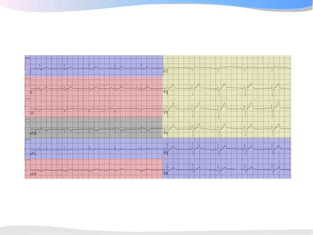 ECGpedia ECG course part II - ischemia, rhythm and conduction | PDF | Heart and Cardiovascular ...