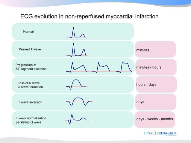 ECGpedia ECG course part II - ischemia, rhythm and conduction | PDF | Heart and Cardiovascular ...