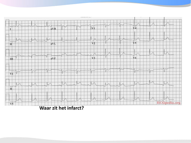 ECGpedia ECG course part II - ischemia, rhythm and conduction | PDF | Heart and Cardiovascular ...