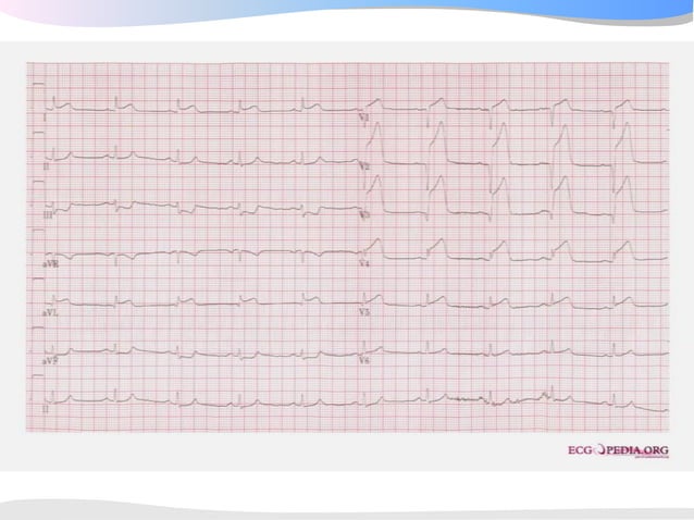 ECGpedia ECG course part II - ischemia, rhythm and conduction | PDF | Heart and Cardiovascular ...