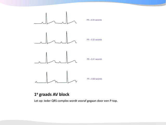 ECGpedia ECG course part II - ischemia, rhythm and conduction | PDF | Heart and Cardiovascular ...