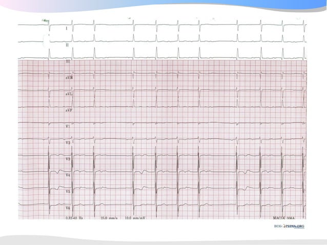 ECGpedia ECG course part II - ischemia, rhythm and conduction | PDF | Heart and Cardiovascular ...