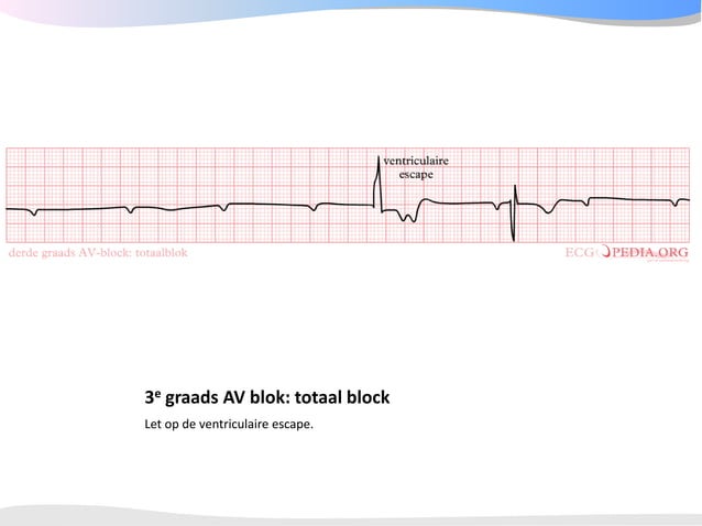 ECGpedia ECG course part II - ischemia, rhythm and conduction | PDF | Heart and Cardiovascular ...
