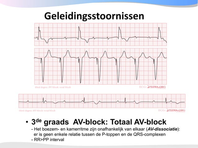 ECGpedia ECG course part II - ischemia, rhythm and conduction | PDF | Heart and Cardiovascular ...