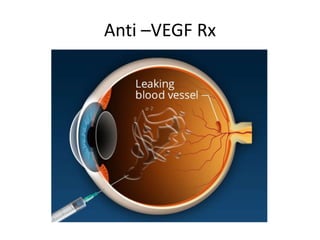 Age related macular degeneration - a glimpse into the future by Jaheed ...