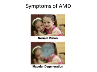 Age related macular degeneration - a glimpse into the future by Jaheed ...