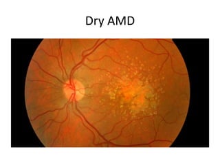 Age related macular degeneration - a glimpse into the future by Jaheed ...