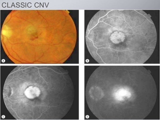 Age related macular degeneration