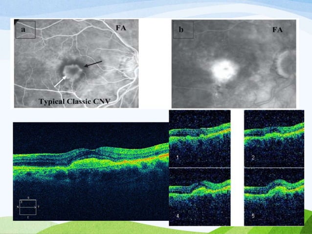 role of oct in diagnosis and ttt of AMD | PPTX