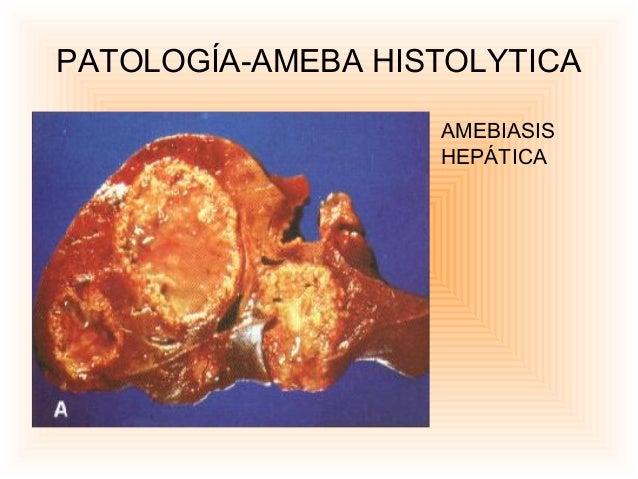 Amebiasis