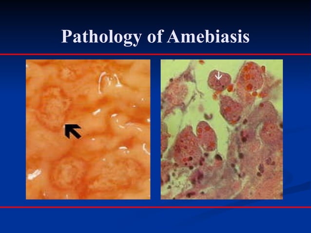amoebiasis A CONCISE NOTES FOR MEDICAL STUDENTS | PPTX