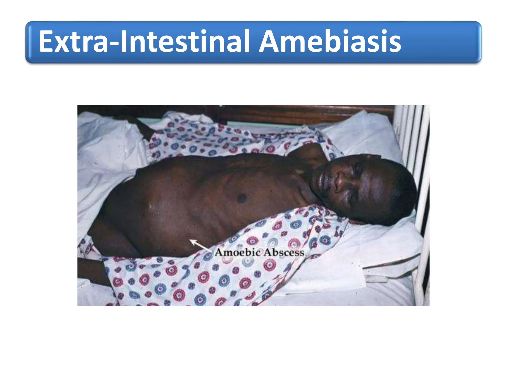 AMEBIASIS and GIARDIASIS in general population | PPT