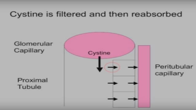 cystinuria | PPT