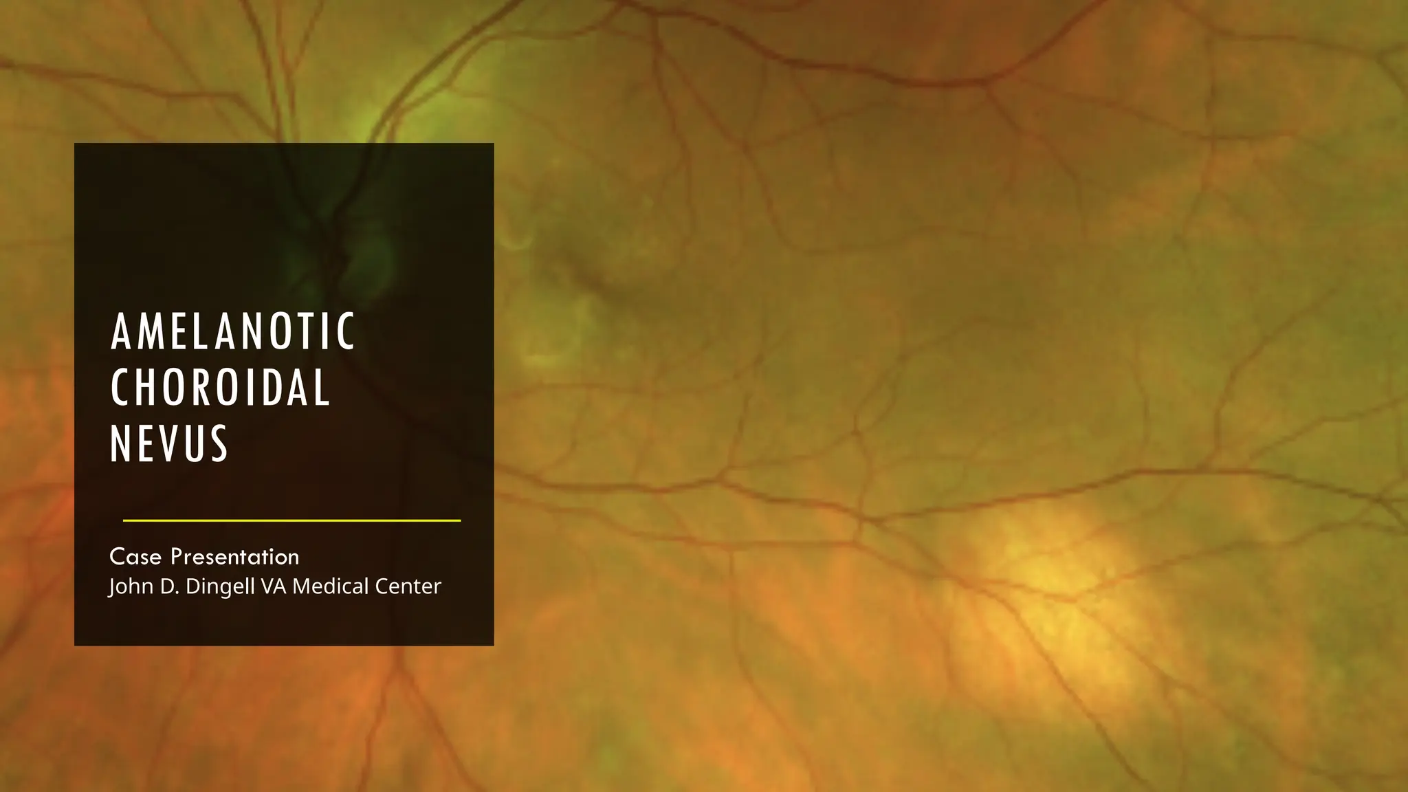 Amelanotic Choroidal Nevus - Case Presentation by Toqua Saflo | PPTX