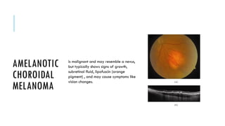 Amelanotic Choroidal Nevus - Case Presentation by Toqua Saflo | PPTX ...
