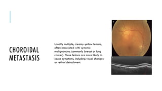 Amelanotic Choroidal Nevus - Case Presentation by Toqua Saflo | PPTX ...