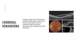 Amelanotic Choroidal Nevus - Case Presentation by Toqua Saflo | PPTX ...