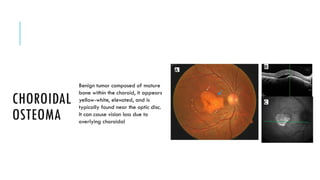 Amelanotic Choroidal Nevus - Case Presentation by Toqua Saflo | PPTX ...