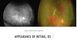 Amelanotic Choroidal Nevus - Case Presentation by Toqua Saflo | PPTX ...