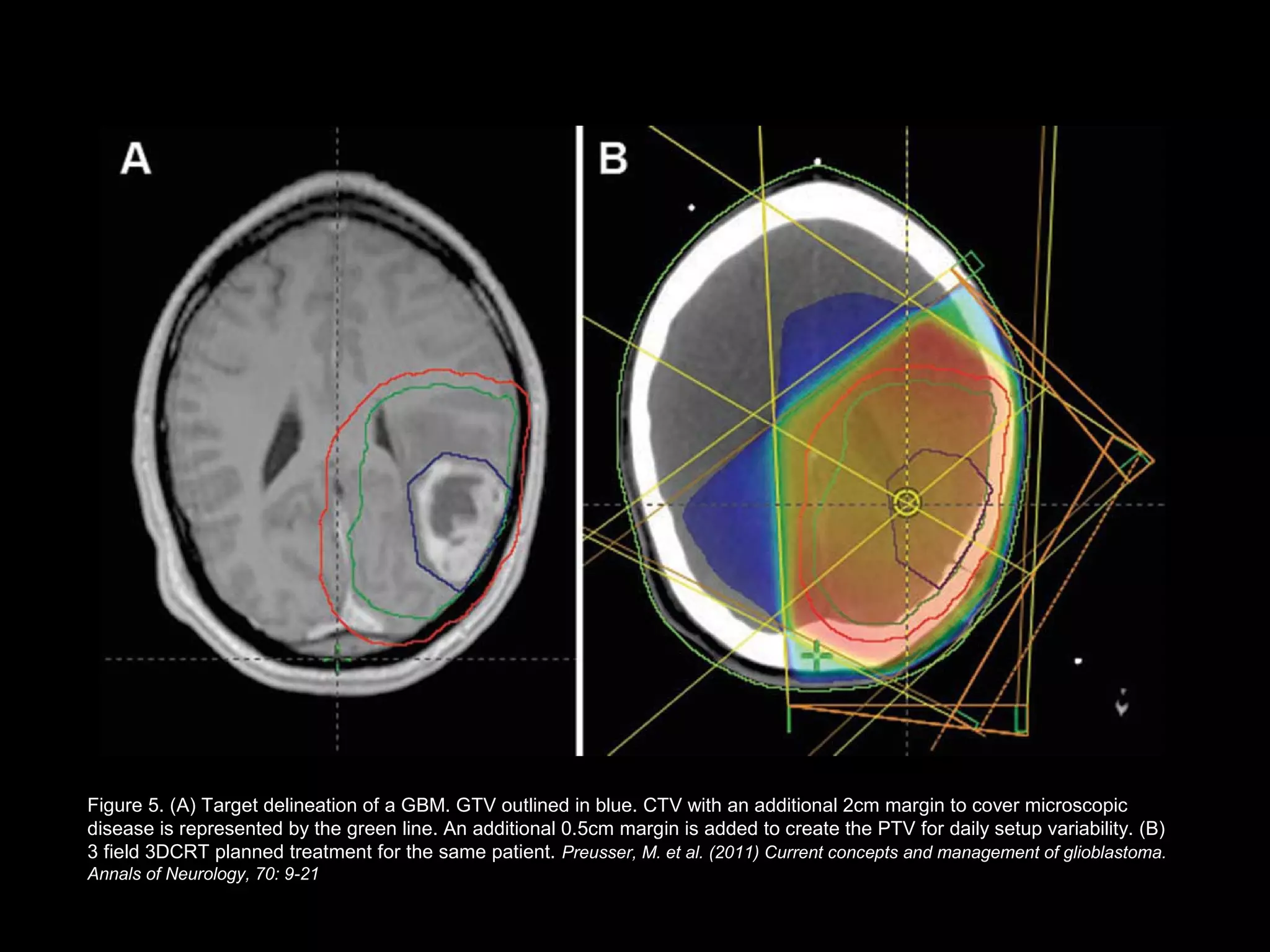 Amelia glioblastoma | PPT