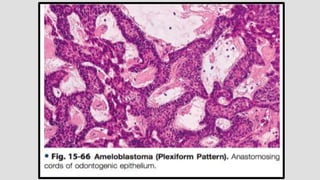 Plexiform Ameloblastoma Histology